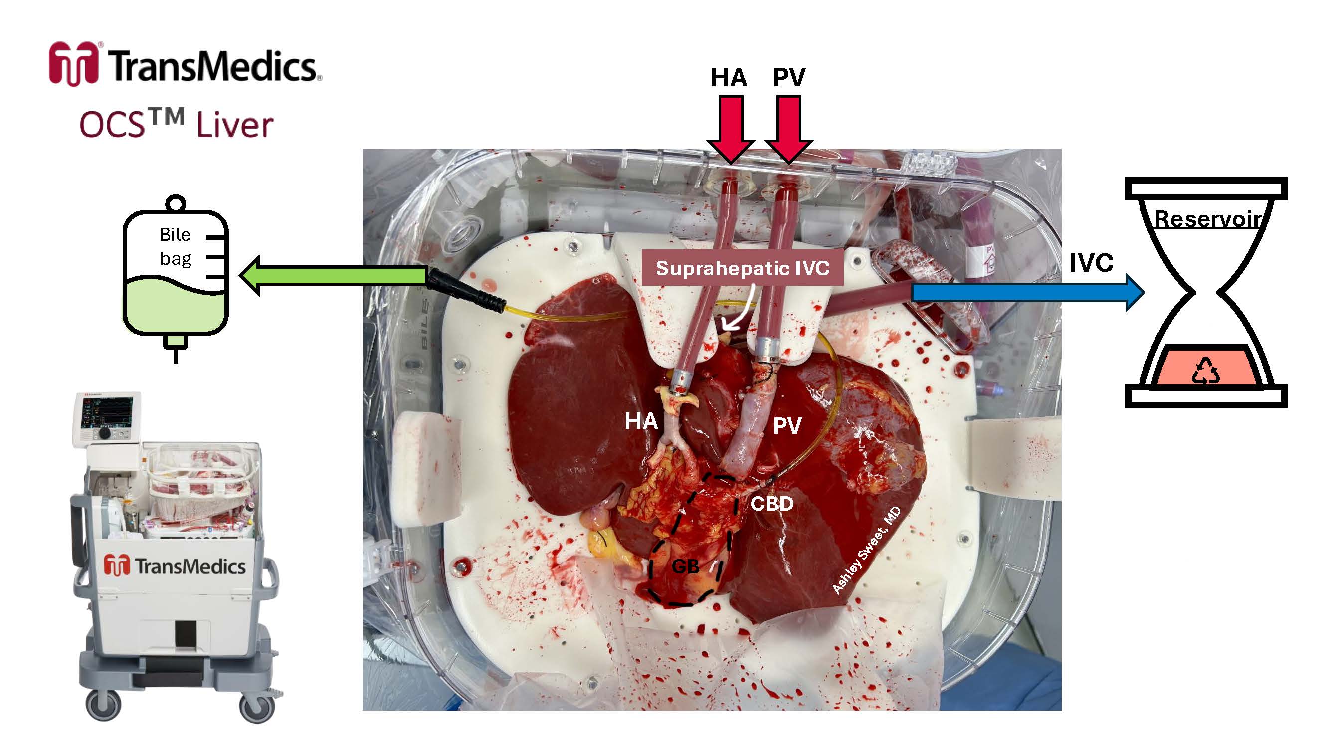 Normothermic Machine Perfusion | AASLD