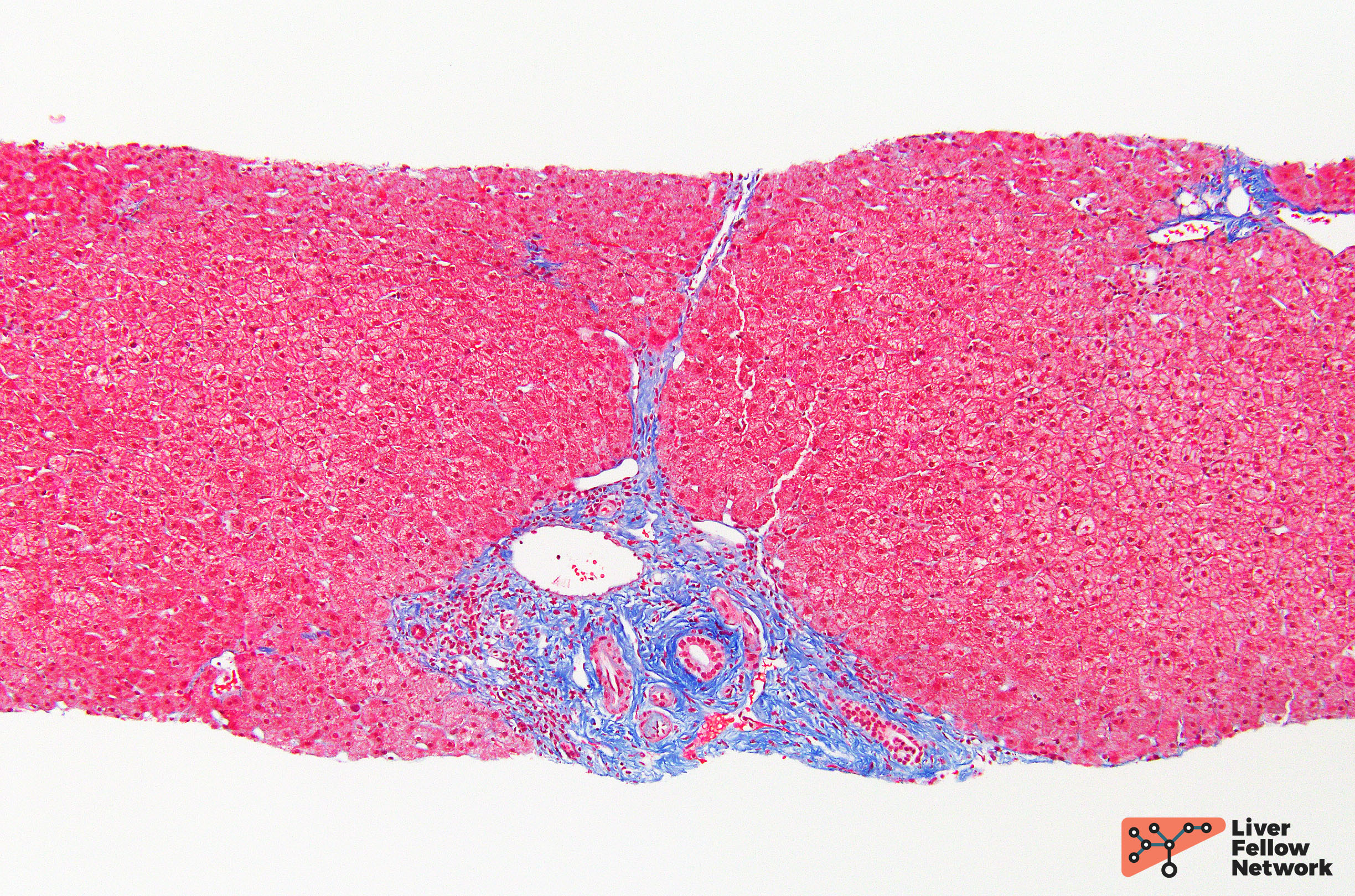 Liver Biopsy Interpretation: Special Stains | AASLD