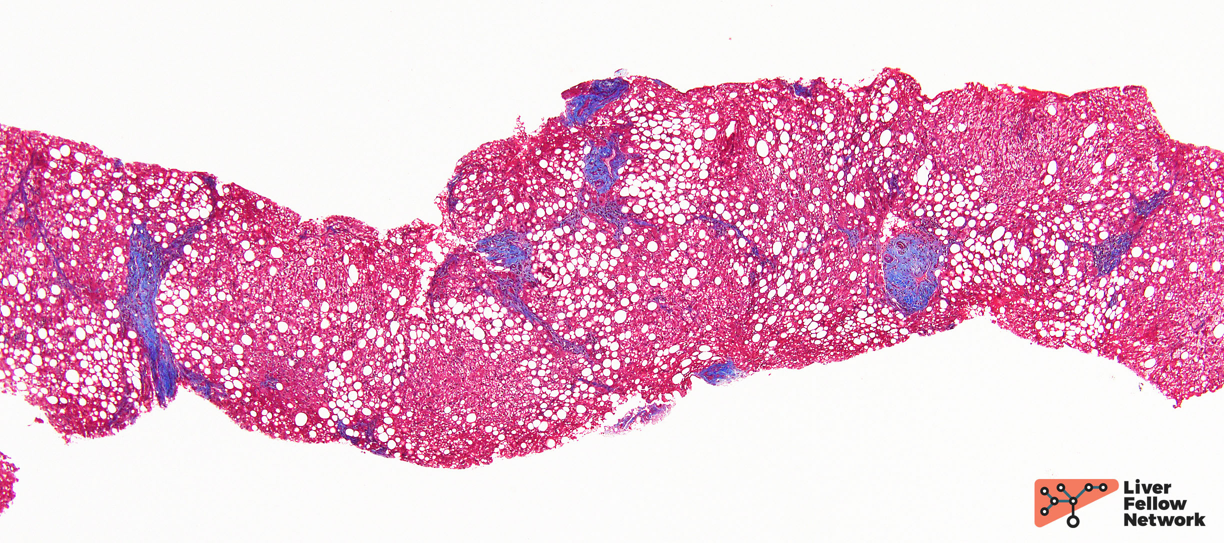 Liver Biopsy Interpretation: Special Stains | AASLD Liver Biopsy Interpretation: Special Stains | AASLD