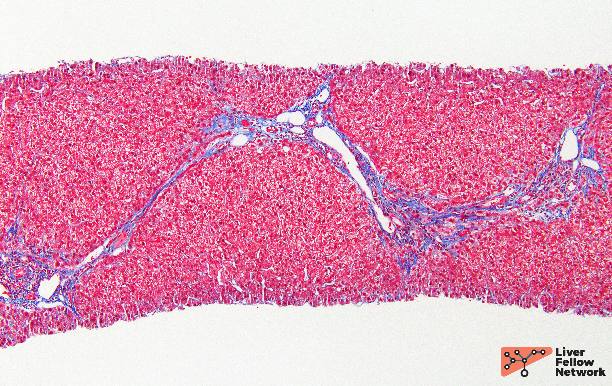 Liver Biopsy Interpretation: Special Stains | AASLD