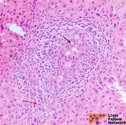 Pathology Pearls: Overlap Syndrome | AASLD
