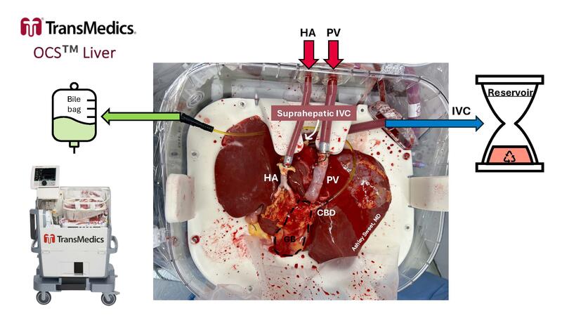 Normothermic Machine Perfusion | AASLD