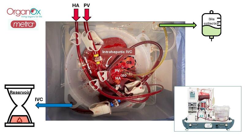 Normothermic Machine Perfusion | AASLD