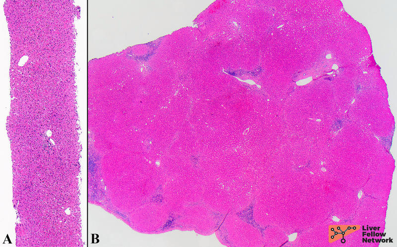 The Liver Biopsy: Importance and Interpretation | AASLD