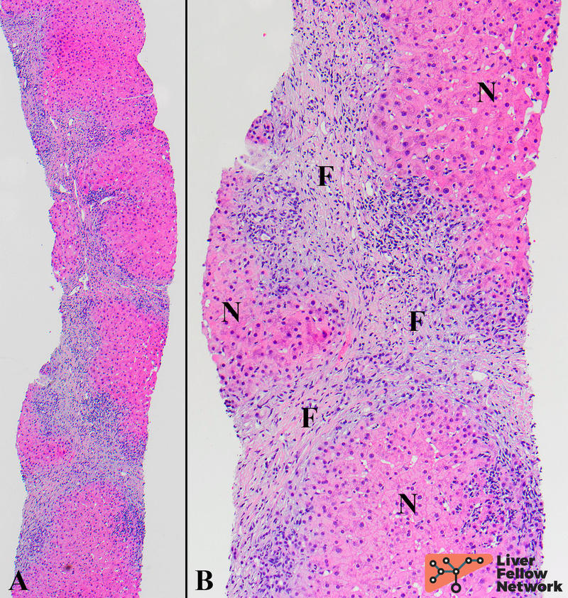 The Liver Biopsy: Importance and Interpretation | AASLD