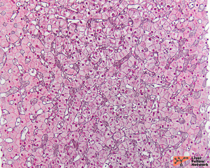 Liver Biopsy Interpretation: Special Stains | AASLD