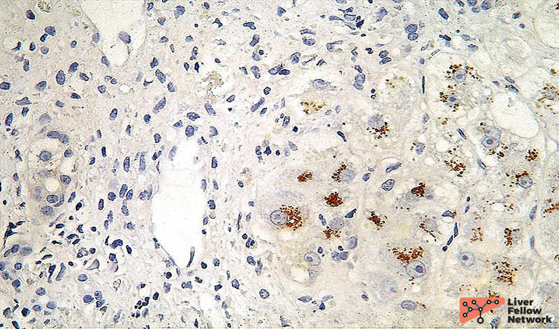 Liver Biopsy Interpretation: Special Stains | AASLD