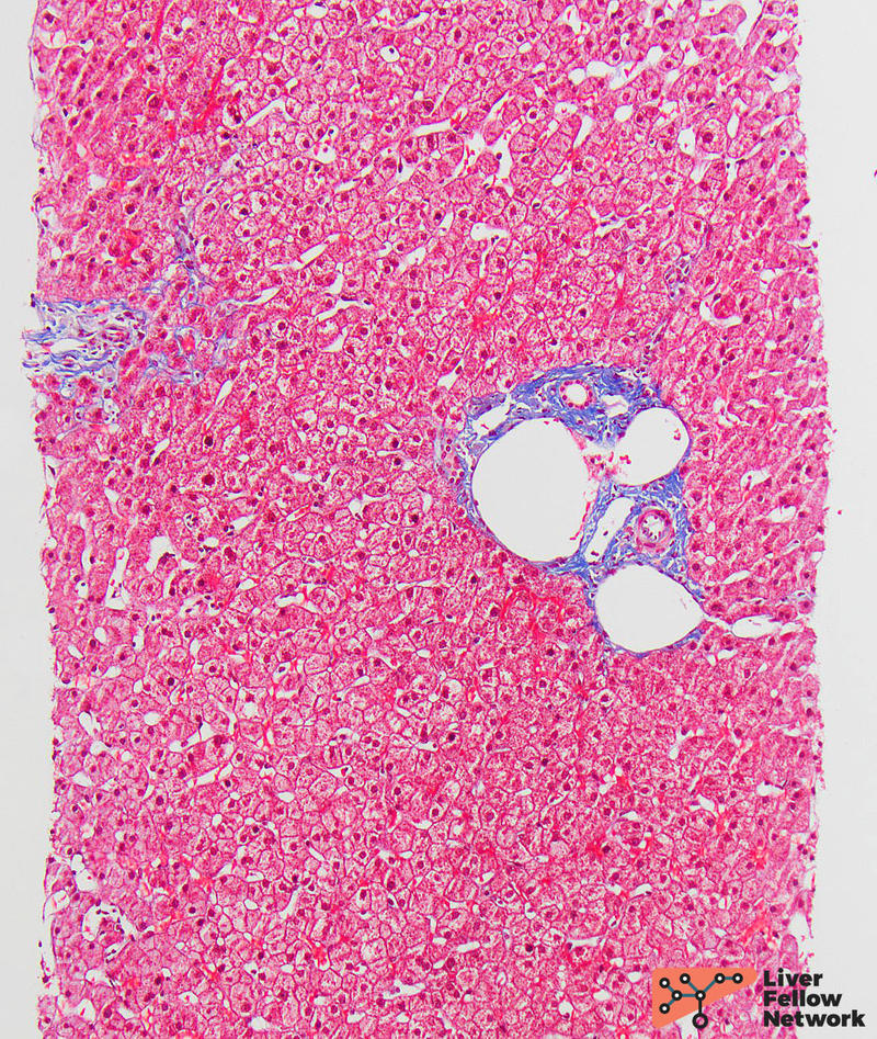 Liver Biopsy Interpretation: Special Stains | AASLD
