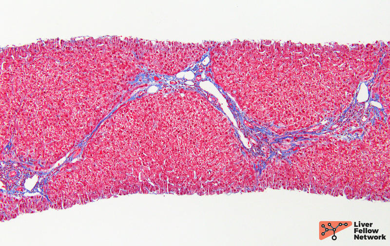 Liver Biopsy Interpretation: Special Stains | AASLD