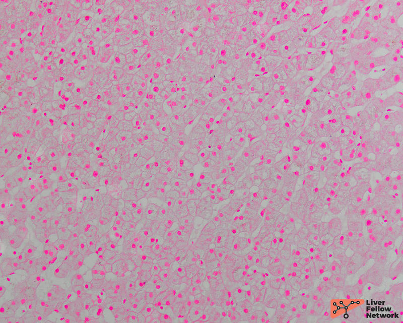 Liver Biopsy Interpretation: Special Stains | AASLD