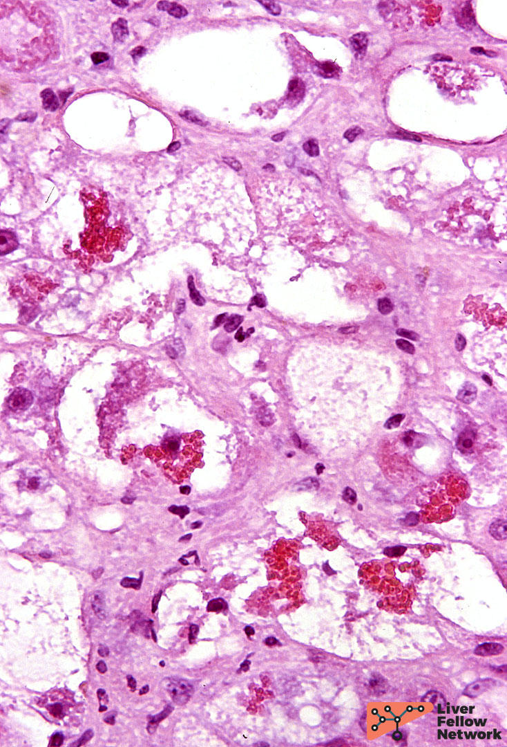 Liver Pathology: Steatohepatitis | AASLD