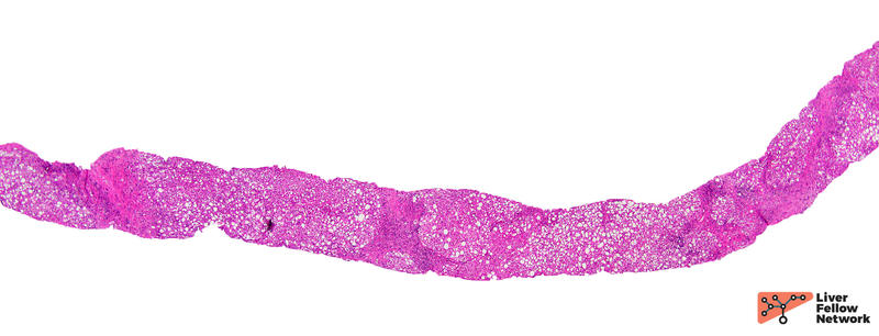 Liver Pathology: Steatohepatitis | AASLD