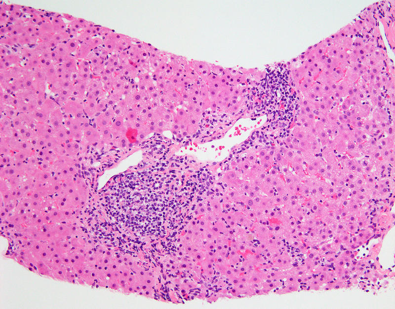 Pathology Pearls Post 5: Chronic Viral Hepatitis | AASLD