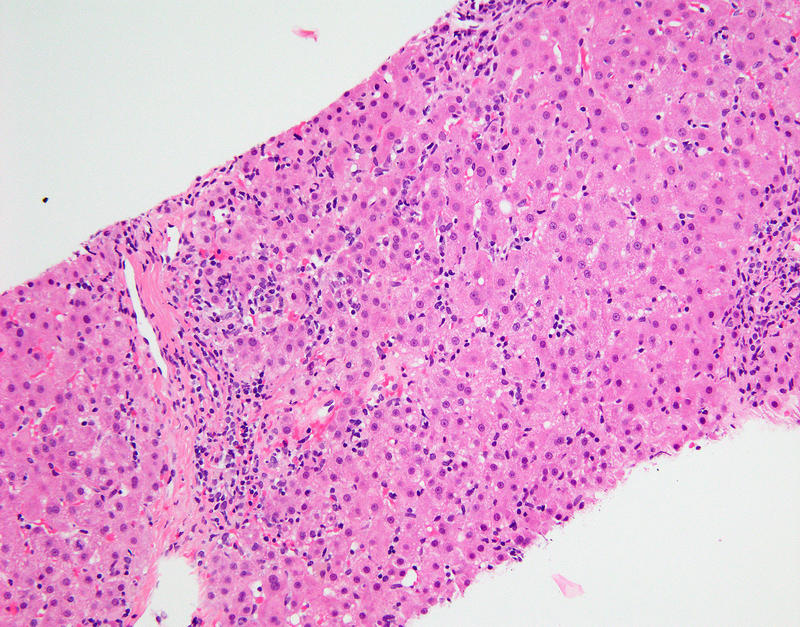 Pathology Pearls Post 5: Chronic Viral Hepatitis | AASLD