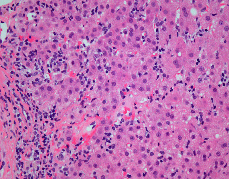 Pathology Pearls Post 5: Chronic Viral Hepatitis | AASLD