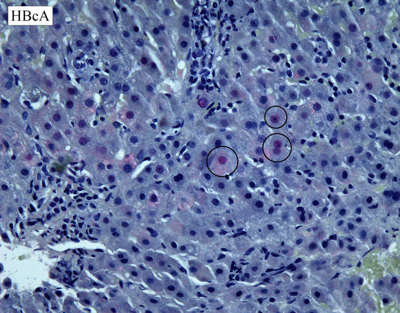 Pathology Pearls Post 5: Chronic Viral Hepatitis | AASLD