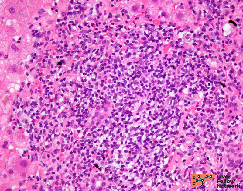 Pathology Pearls Post 6: Autoimmune Hepatitis (AIH) | AASLD