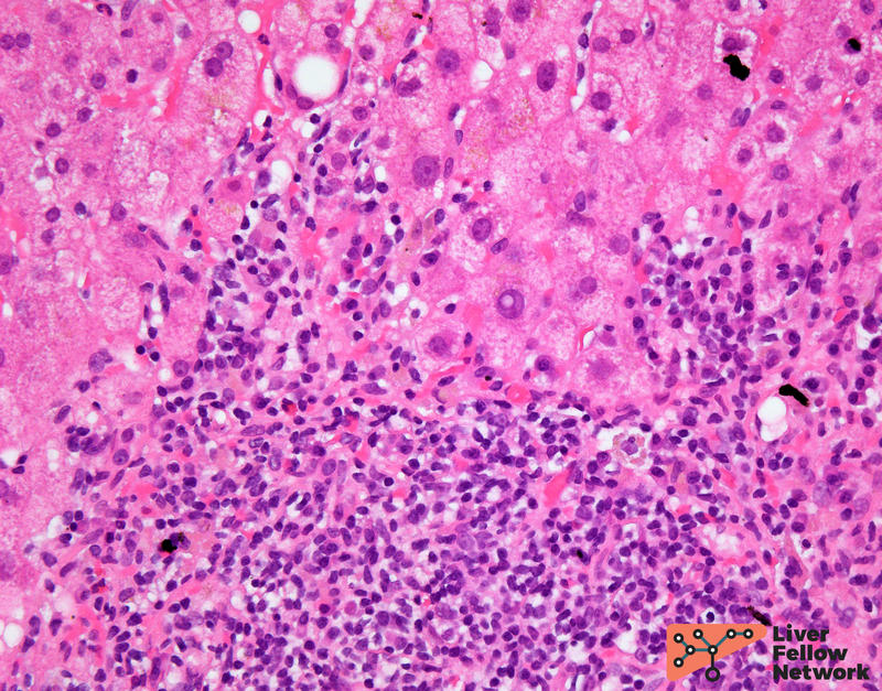 Pathology Pearls Post 6: Autoimmune Hepatitis (AIH) | AASLD