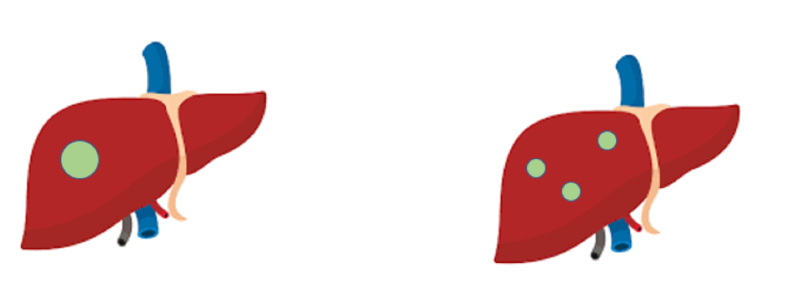 Why do we use the model for end-stage liver disease (MELD) score?: Part ...