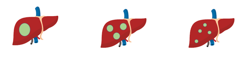 Why do we use the model for end-stage liver disease (MELD) score?: Part ...