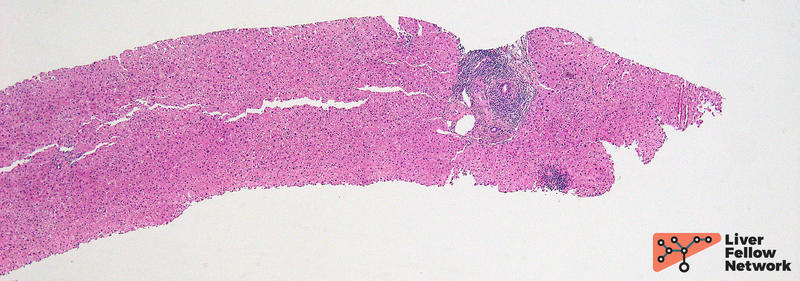 Pathology Pearls Post 7 Primary Biliary Cholangitis Aasld