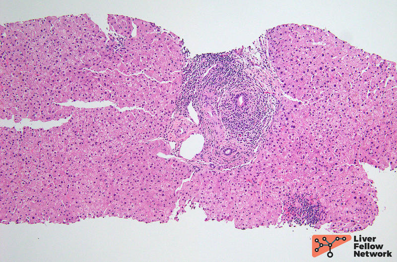Pathology Pearls Post 7: Primary Biliary Cholangitis | AASLD