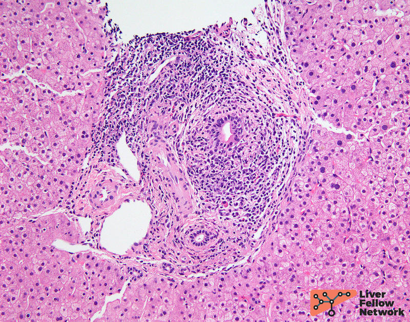 Pathology Pearls Post 7: Primary Biliary Cholangitis | AASLD
