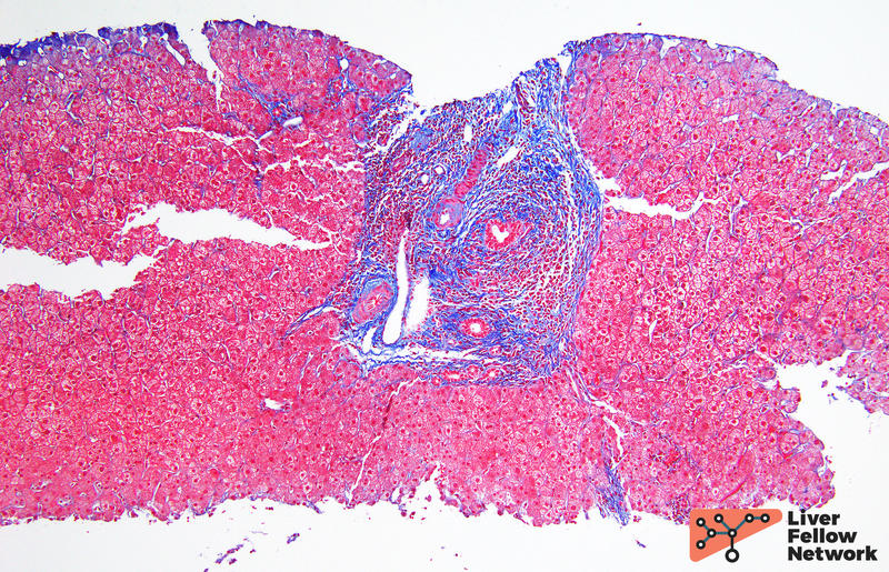 Pathology Pearls Post 7: Primary Biliary Cholangitis | AASLD