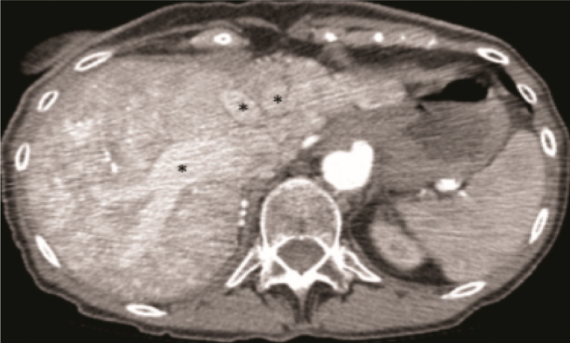 What happens to the liver when blood vessels go rogue | AASLD