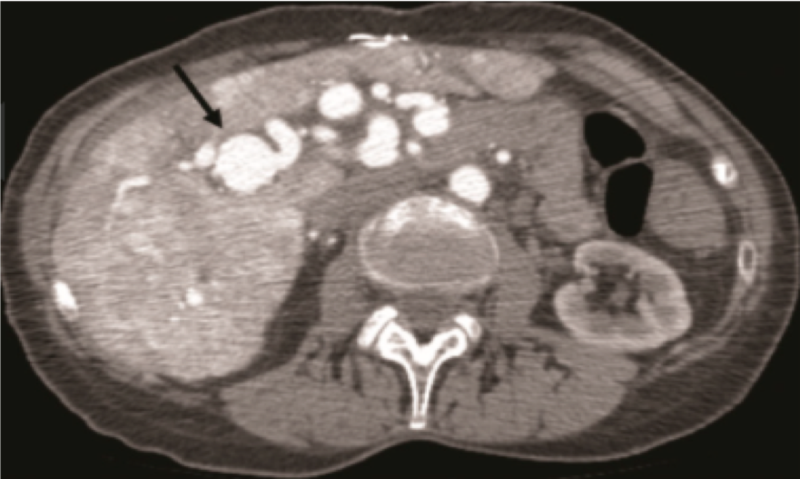 What happens to the liver when blood vessels go rogue | AASLD