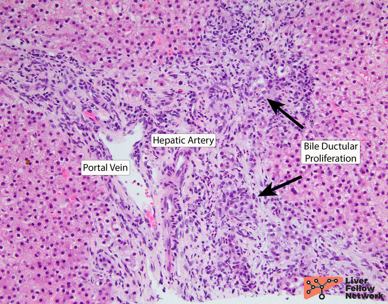 Pathology Pearls Post 8: Primary Sclerosing Cholangitis (PSC) | AASLD