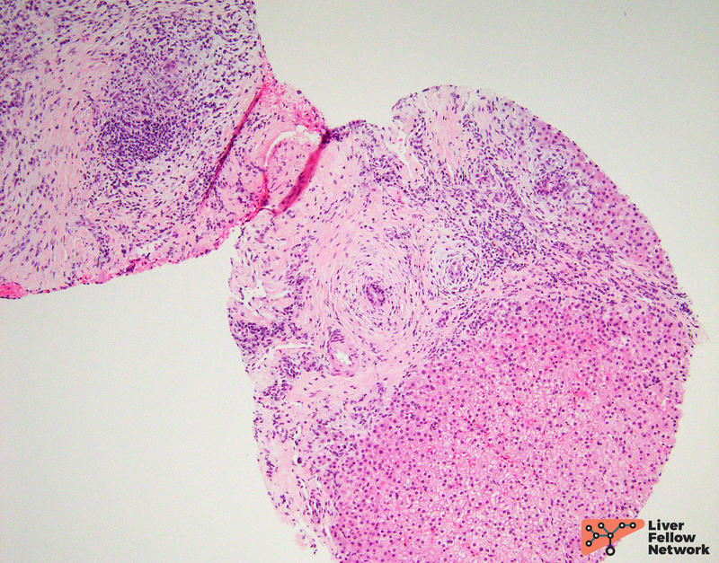 Pathology Pearls Post 8: Primary Sclerosing Cholangitis (PSC) | AASLD