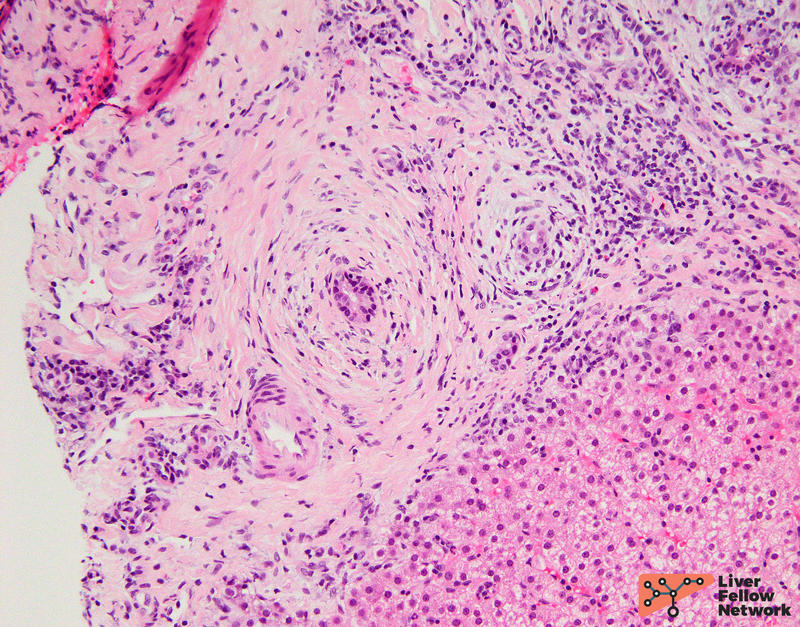 Pathology Pearls Post 8: Primary Sclerosing Cholangitis (PSC) | AASLD