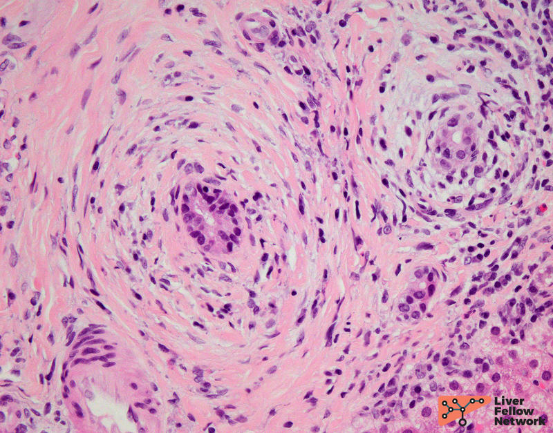 Pathology Pearls Post 8: Primary Sclerosing Cholangitis (PSC) | AASLD