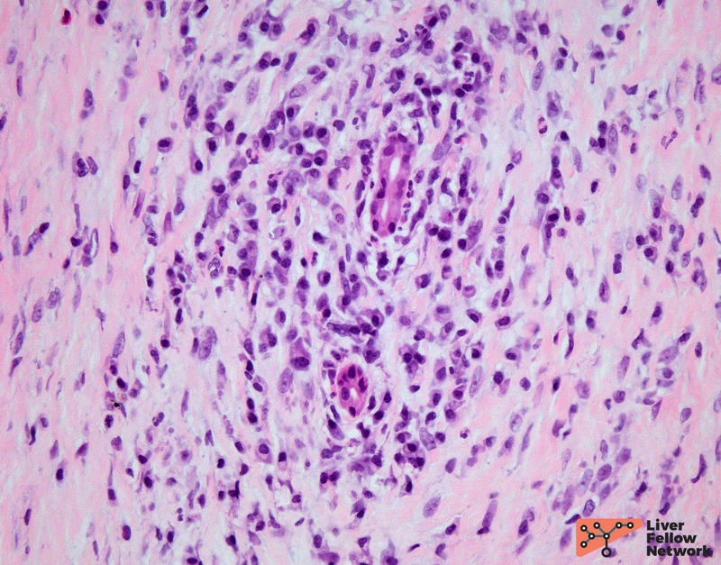 Pathology Pearls Post 8: Primary Sclerosing Cholangitis (PSC) | AASLD