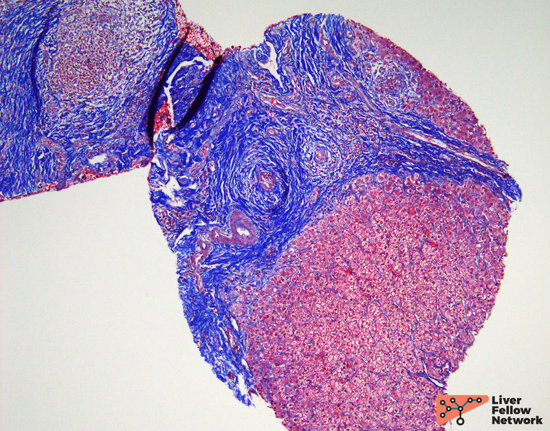 Pathology Pearls Post 8: Primary Sclerosing Cholangitis (PSC) | AASLD