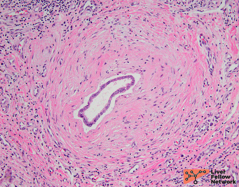 Pathology Pearls Post 8: Primary Sclerosing Cholangitis (PSC) | AASLD