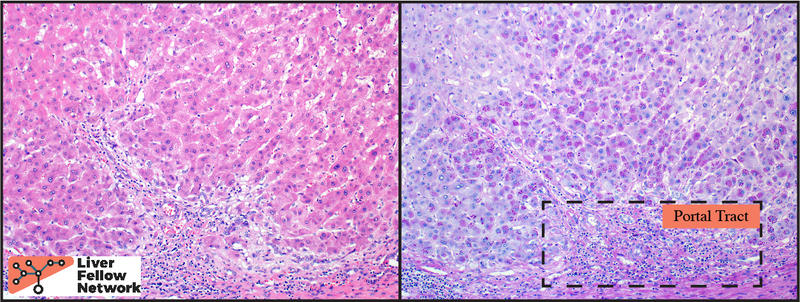Pathology Pearls: Alpha-1 antitrypsin deficiency | AASLD