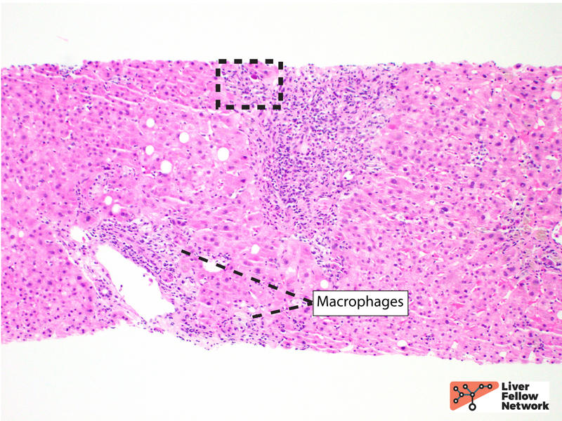 Pathology Pearls: Immune Checkpoint Inhibitor Hepatitis | AASLD