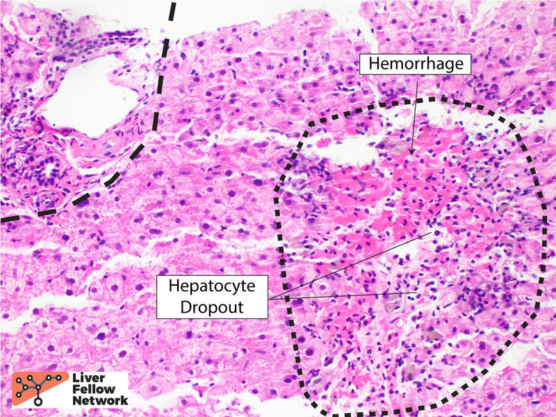 Pathology Pearls: Immune Checkpoint Inhibitor Hepatitis | AASLD
