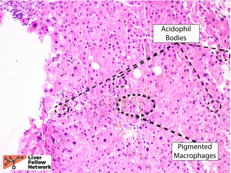 Pathology Pearls: Immune Checkpoint Inhibitor Hepatitis | AASLD