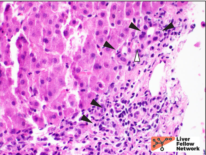 Pathology Pearls: Immune Checkpoint Inhibitor Hepatitis | AASLD