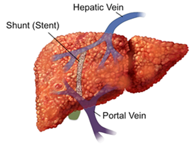 Why do we use early TIPS for the management of variceal bleeding? | AASLD