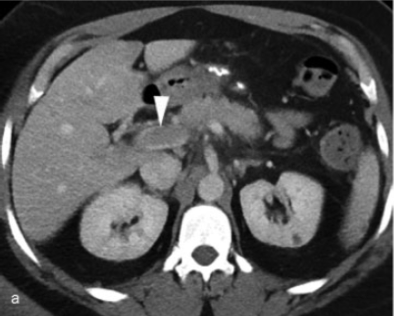 Quelling the Swelling | AASLD