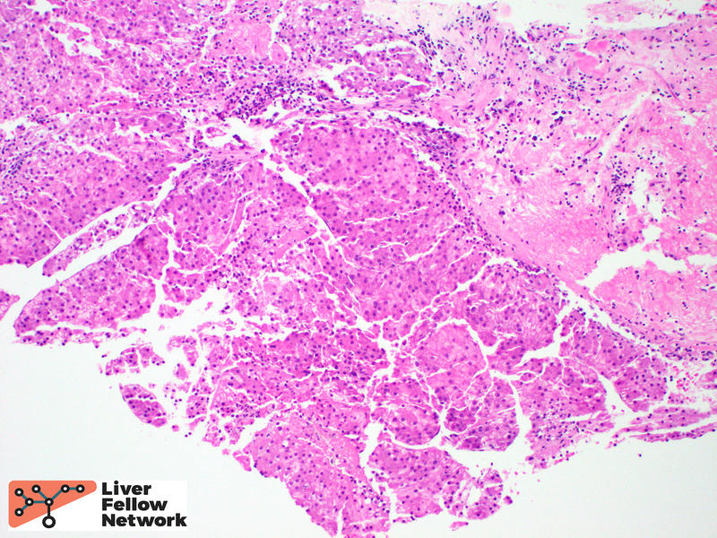 Pathology Pearls: Hepatocellular Carcinoma | AASLD
