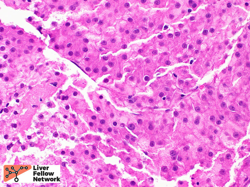 Pathology Pearls: Hepatocellular Carcinoma | AASLD