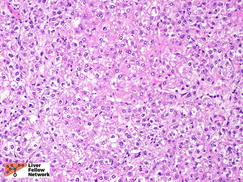Pathology Pearls: Hepatocellular Carcinoma | AASLD