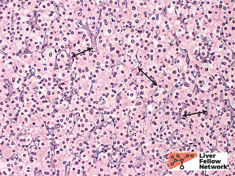 Pathology Pearls: Hepatocellular Carcinoma | AASLD