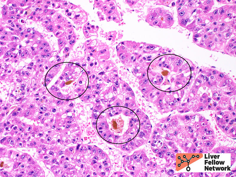 Pathology Pearls: Hepatocellular Carcinoma | AASLD