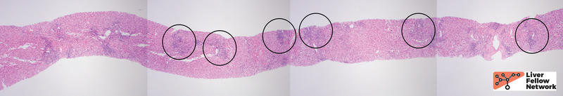 Pathology Pearls: Acute Cellular Rejection | AASLD
